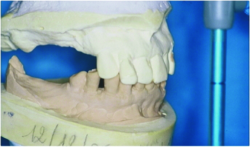 Le pas à pas d'un traitement par prothèse composite - Prothèse amovible ...