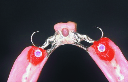 L'apport de l'implantologie en prothèse composite - Prothèse amovible ...