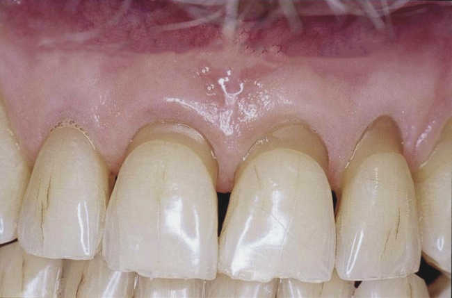 Comprendre l'usure des dents. - 12e journées de chirurgie dentaire à l ...