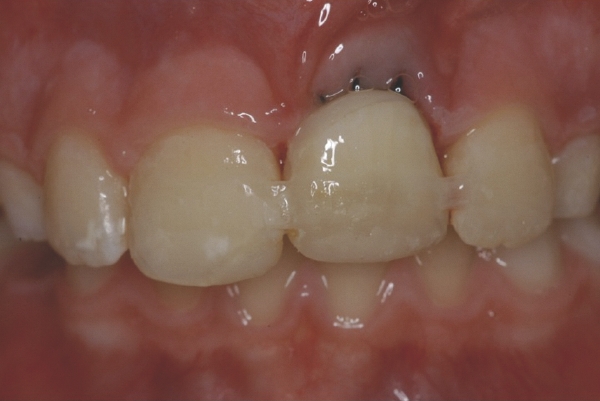La décoronation - L'urgence traumatique de la dent permanente - Comptes ...