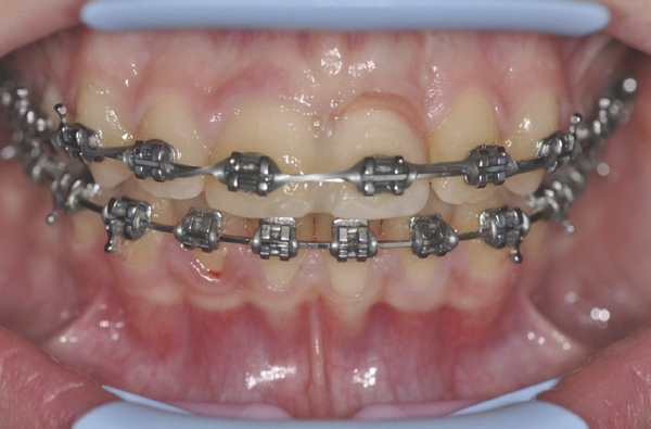 La décoronation - L'urgence traumatique de la dent permanente - Comptes ...